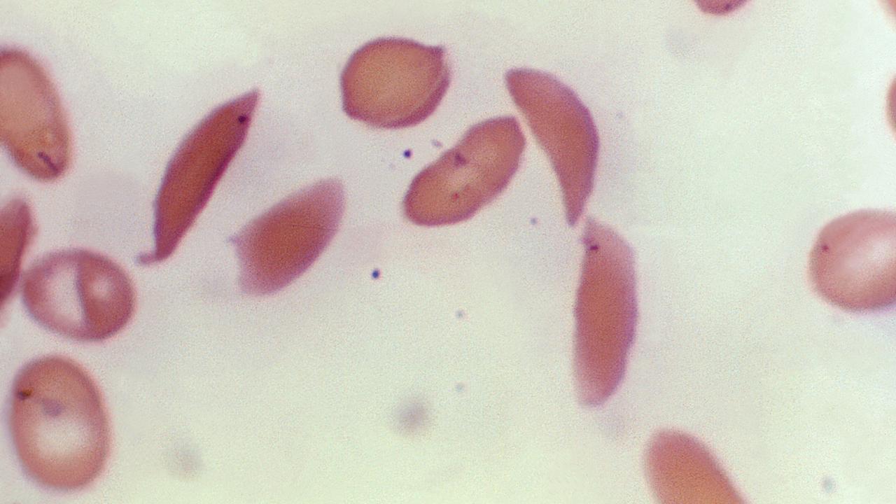 Mit Crispr-Cas gegen Sichelzellen-Krankheit - 3sat-Mediathek